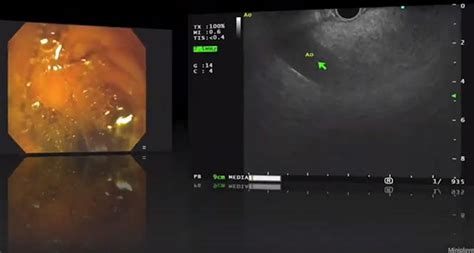 Endoscopy Campus Impn Fukuoka Classification Guidelines