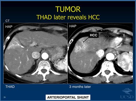 Ppt Imaging Of Thid And Thad Powerpoint Presentation Free Download Id 556144