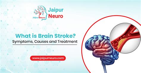 What Is Brain Stroke Symptoms Causes And Treatment