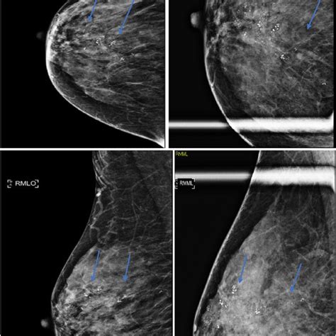 Mammographic Architectural Distortion With Ilc An 87 Year Old Woman Download Scientific