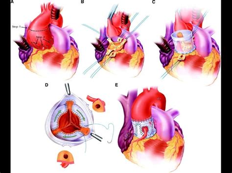 Aorta Intro Ppt Heart And Cardiovascular Diseases Diseases And