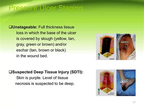 Pressure Ulcerppt