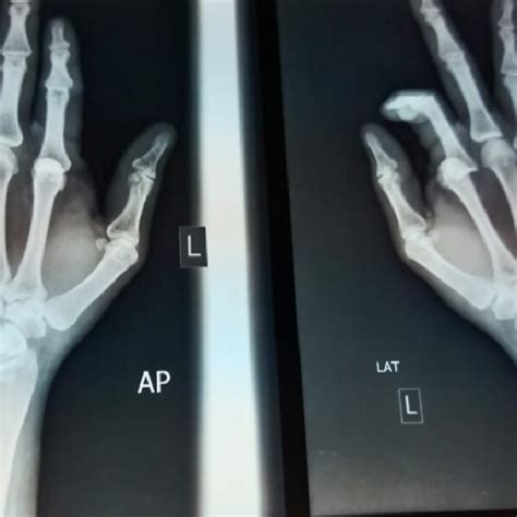 Radiographs Showing The Dislocation Download Scientific Diagram