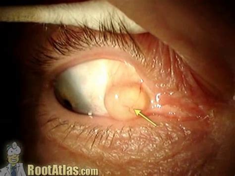 Conjunctival Retention Cyst