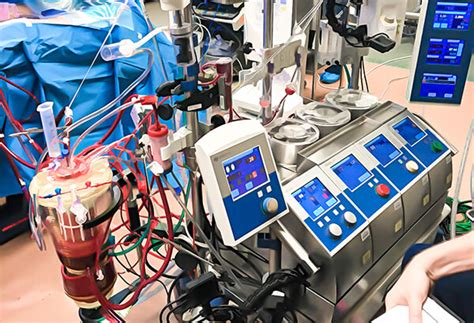 Houston Extracorporeal Technologies Perfusion Services Ecmo Management