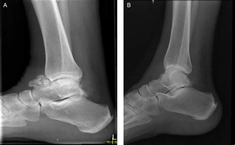 Primary Synovial Chondromatosis Of The Ankle Joint Presenting As
