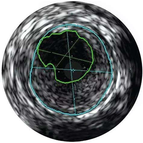 Peripheral Ivus Philips