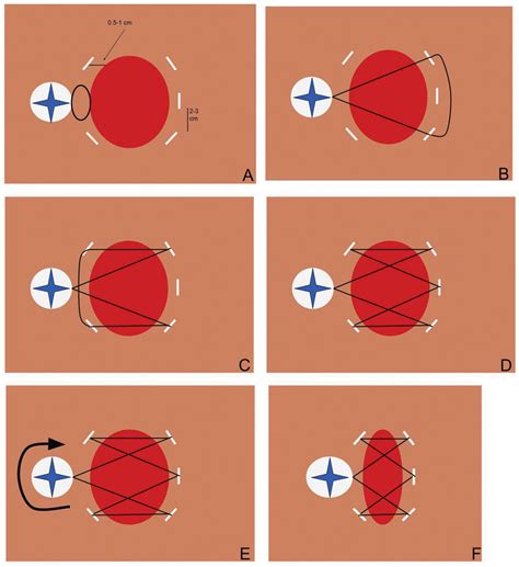 A Diagram Demonstrating The Appropriate Application Of The Dermaclose