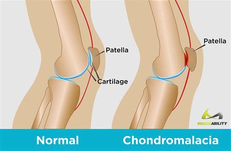 Chondromalacia Symptoms Causes Treatment By Knee Braces