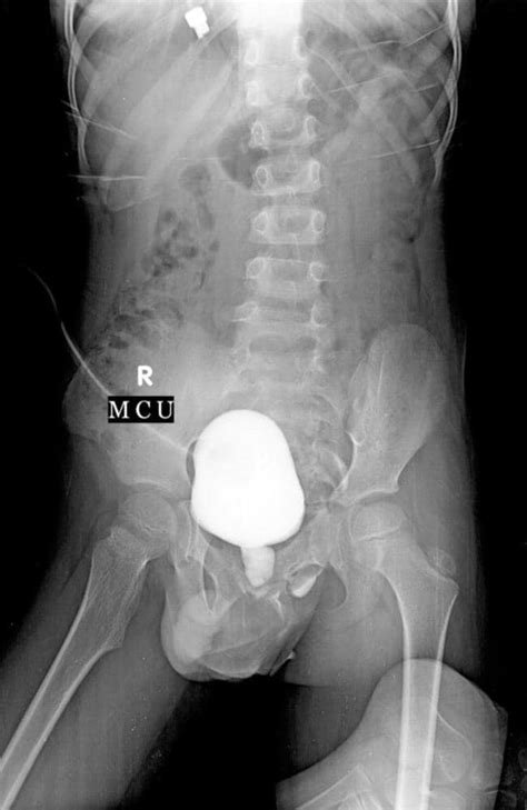 Doctors Find Pen Tip In Boys Penis In Rare Medical Case