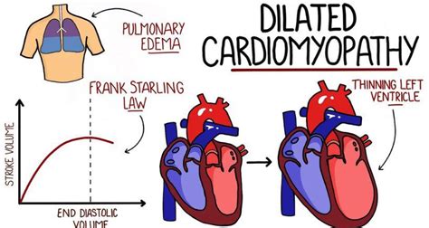 Dilated Cardiomyopathy Causes Warning Signs And Diagnosis