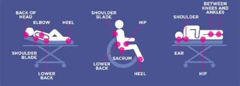 Decubitus Ulcers Symptoms Treatment And Prevention