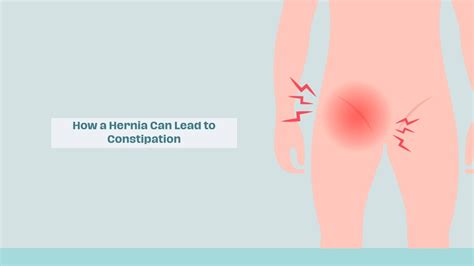 Ppt Hernia And Constipation Understand The Link Powerpoint