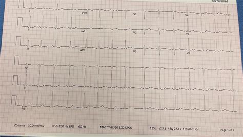 Ectopic Atrial Rhythm