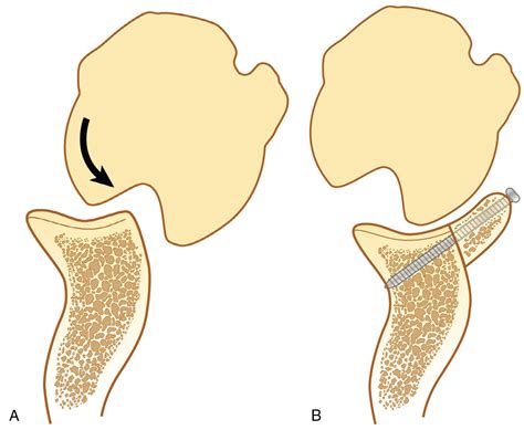 Coracoid Transfer The Open Latarjet Procedure For The Treatment Of