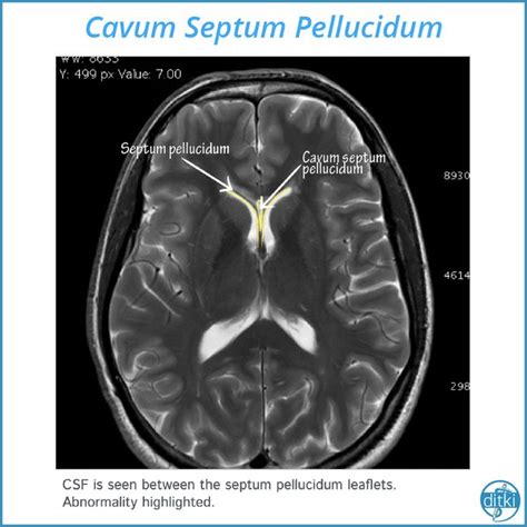 Septum Pellucidum Mri