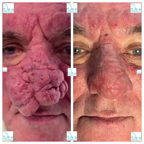Rhinophyma Before After