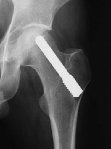 Core Decompression For The Treatment Of Osteonecrosis Of The Femoral Head Musculoskeletal Key