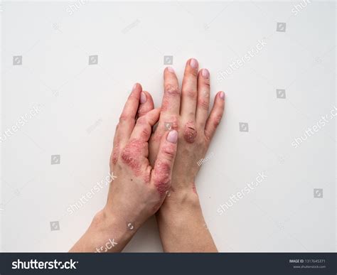 Psoriasis Skin Closeup Rash Scaling On Stock Photo Shutterstock