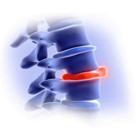 Sciatica And Endometriosis Maxmorespine