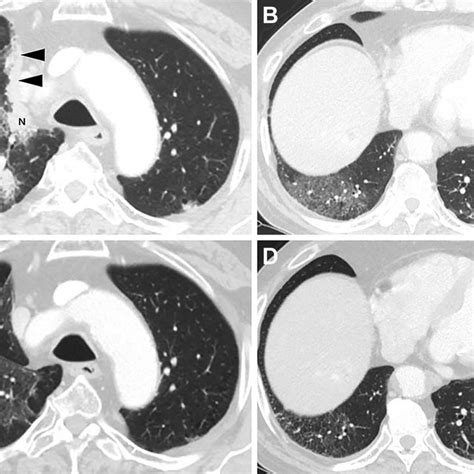 Chest X Ray Revealed Bilateral Interstitial Micronodular Pattern