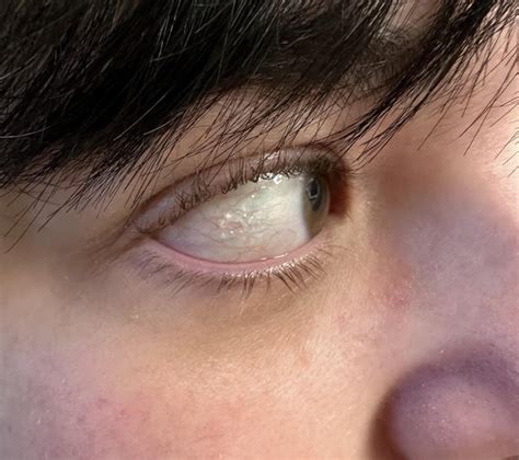 Weird Bumpy Things R Sarcoidosis