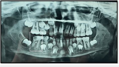 Pre Operative Radiograph Orthopantogram Opg Shows Incomplete Root