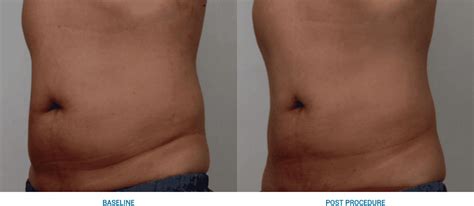 Hifu Treatment London Premier Laser Clinic