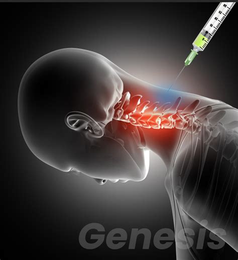 Stellate Ganglion Block Genesis