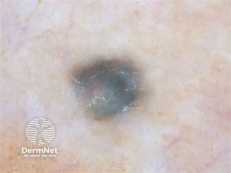 Junctional Nevus Dermoscopy
