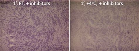 Hematoxylin Stain Of 8 M M Breast Cancer Tissue Cryosection Staining