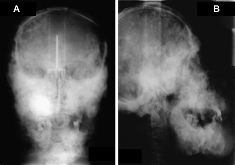 Pagets Disease Mandible At Lindy Rossi Blog