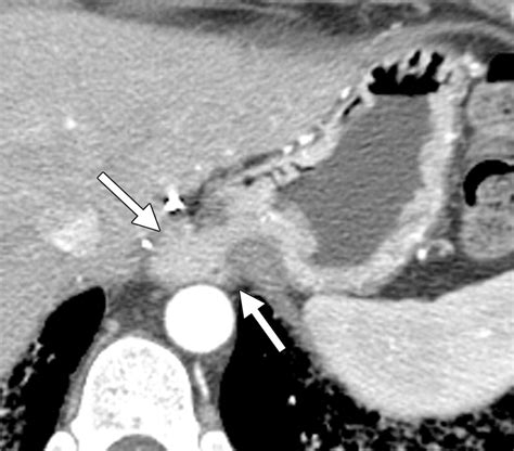Imaging Findings Of Successful And Failed Fundoplication Radiographics