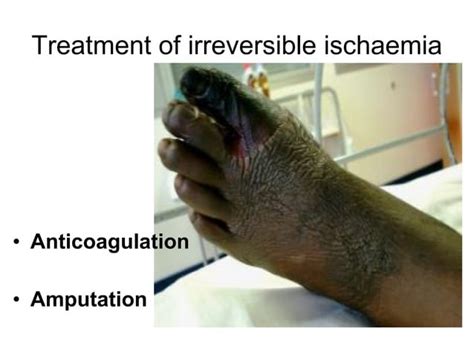 Acute Limb Ischemia Ppt