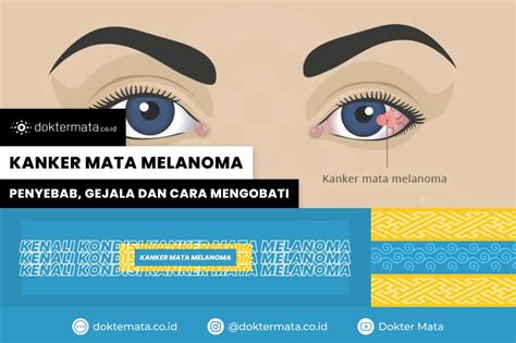 Kanker Mata Melanoma Penyebab Gejala Dan Cara Mengobati