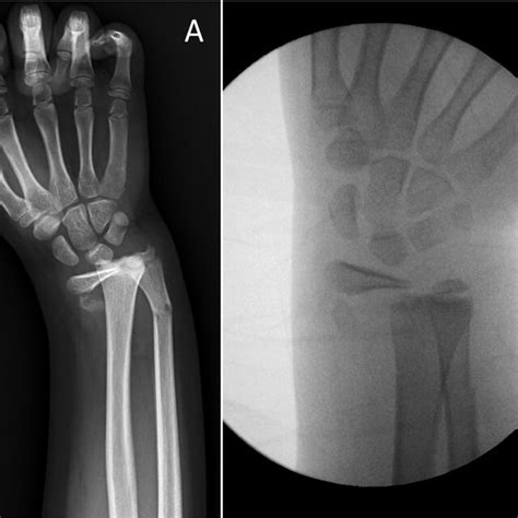 A Left Wrist Anteroposterior Radiograph B Radiograph Following