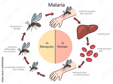 Malaria Disease Diagram Hand Drawn Schematic Vector Illustration Medical Science Educational