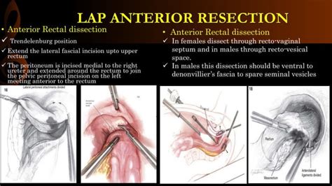 Lap Anterior Resection Step By Step Operative Surgerypptx