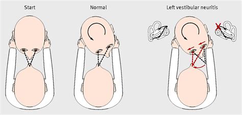 Eye Movement With Vertigo At Joan Ruhl Blog