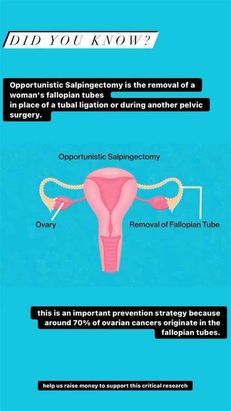 Opportunistic Salpingectomy During Hysterectomy