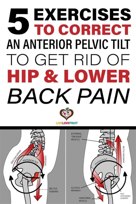 Graphic Anatomical Representation Of Anterior Pelvic Tilt With Text 5