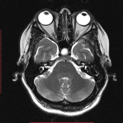 Empty Sella Empty Sella Radiology Case