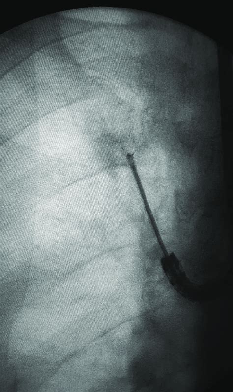 Reconstruction Provided By Ct Scan And Assisted By Fluoroscopy Or