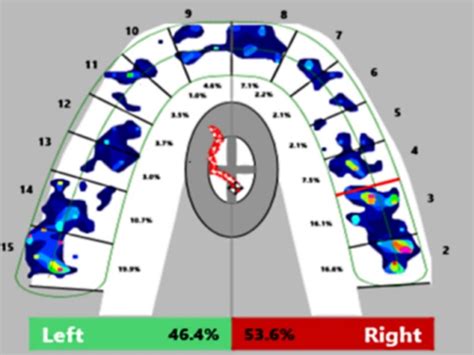 In Vitro Consistency Testing Of The T Scan 10 Relative Force Measurement System Published In