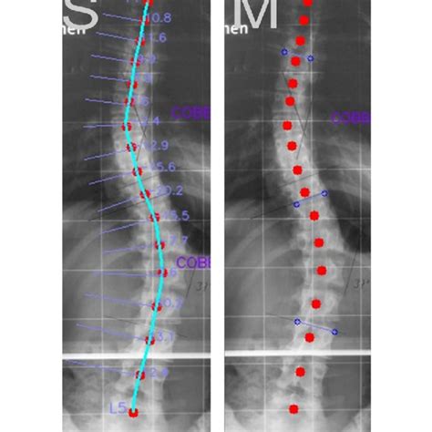 S Manually Labeled Vertebrae Red Dots Were Used To Algorithmically