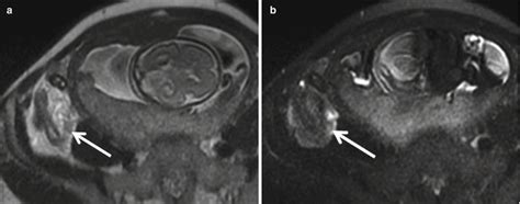 Mri Of Appendicitis And Bowel Diseases In Pregnancy Radiology Key