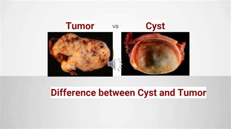 Malignant Tumor