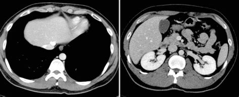 Multiple Tiny Liver Abscesses In Abdomen Ct Download Scientific Diagram