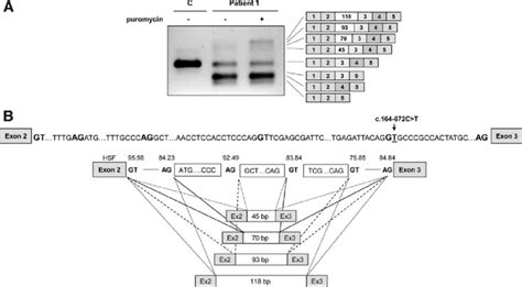 Pts Gene Splicing Profile In Patient 1 Fibroblasts A Rt Pcr Analysis