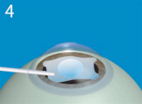 Ipcl Implantable Phakic Contact Lens｜医療法人 慈明会 こうやま眼科｜枚方の白内障手術・眼科診療
